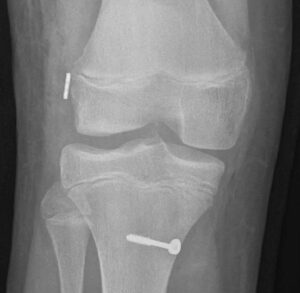 Paediatric ACL injuries | Dr Graeme Brown